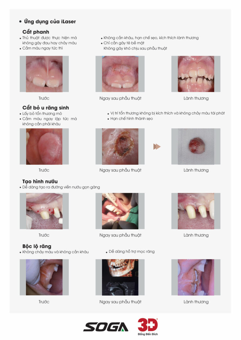 Máy Laser Soga - DIGITAL DENTAL SOLUTIONS